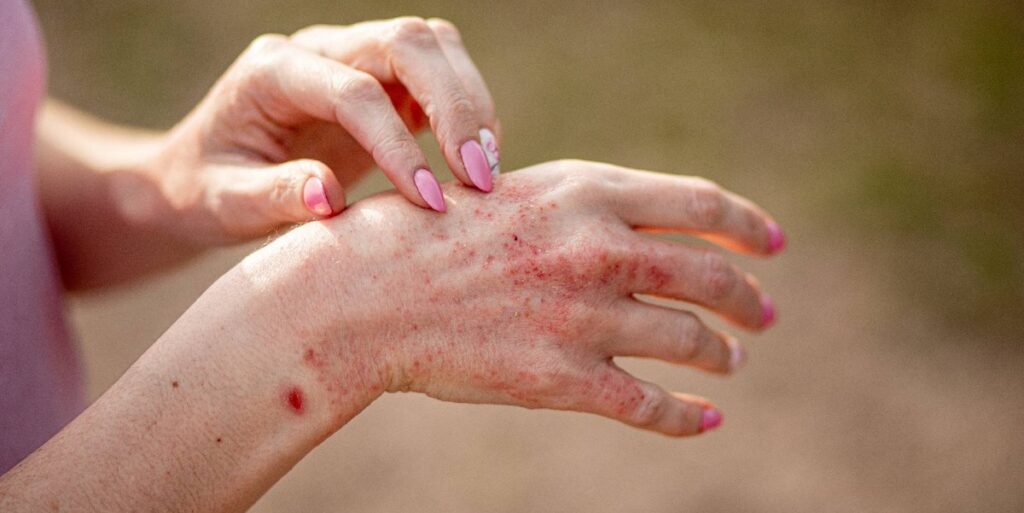 Atopic Dermatitis: Causes, Symptoms, and Treatment | Feinstein Dermatology